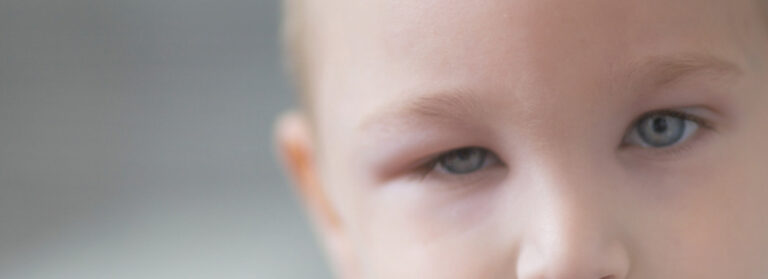 Olho inchado: o que pode ser? - SPX Imagem