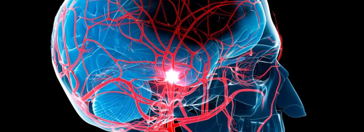 Desvendando os Mitos e Verdades sobre o AVC