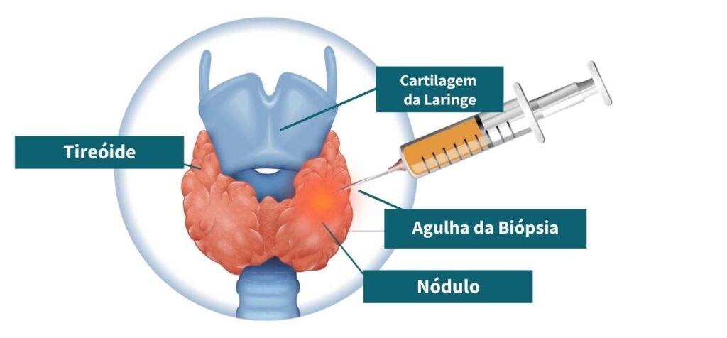 Para que serve a Biópsia de Tireóide?