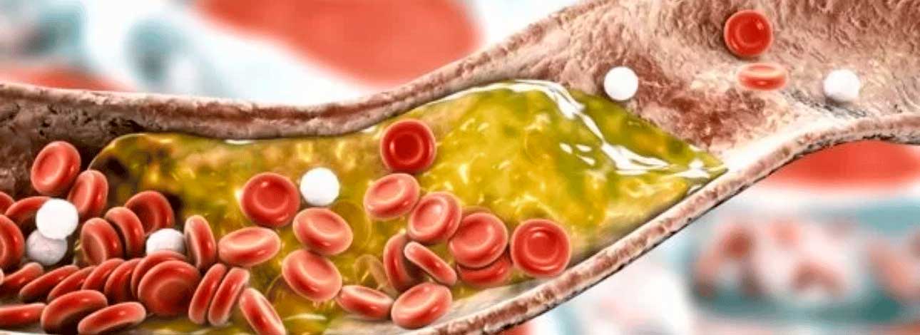 Conheça o Novo Medicamento para Reduzir o Colesterol Ruim