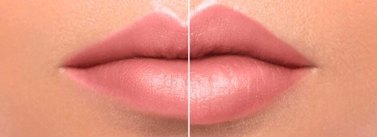 O Que é o Preenchimento Labial? Saiba os Detalhes e os Riscos