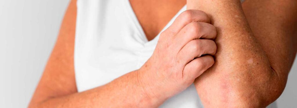 Como Identificar Colesterol Alto na Pele? Veja 5 Sintomas