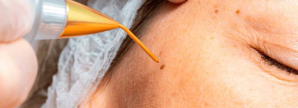 Cauterização e Exérese de Verrugas: O Que é e Como Funciona?