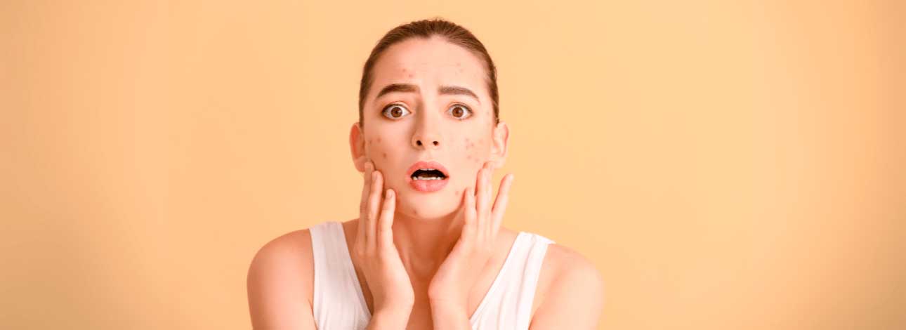 Como Tratar Acne Severa? Veja Dicas e Cuidados para a Pele